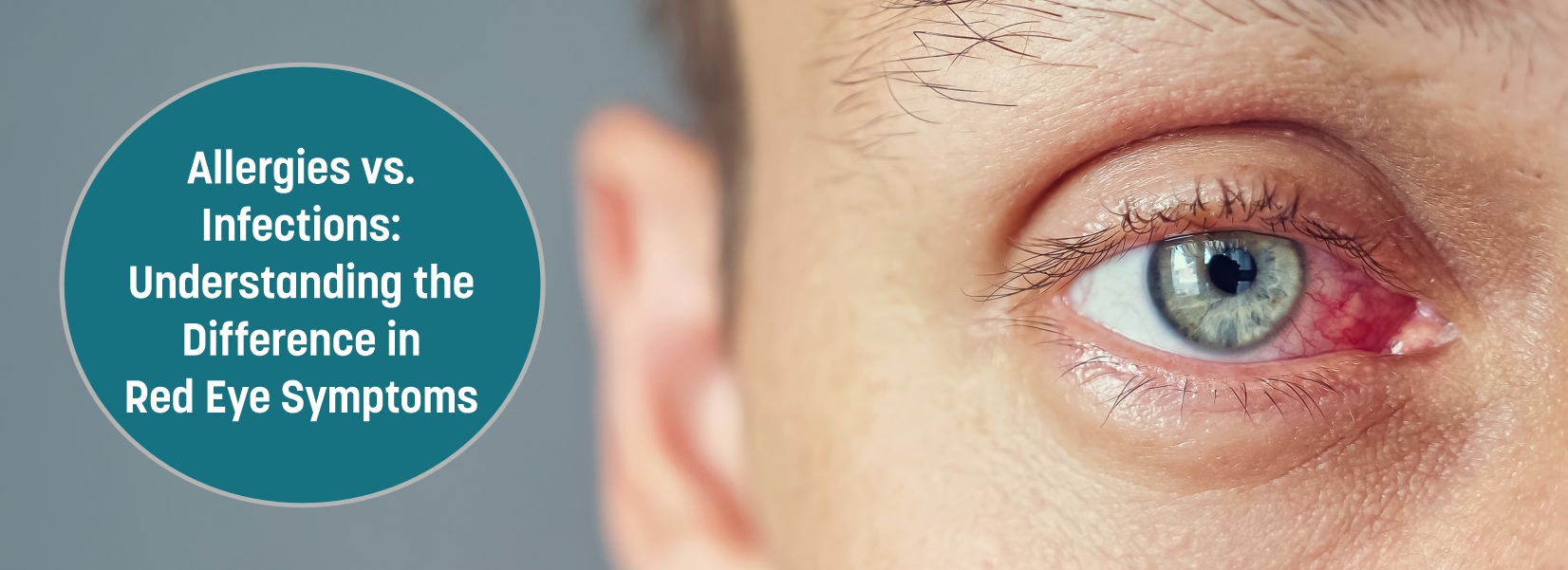 Allergies vs. Infections: Understanding the Difference in Red Eye ...