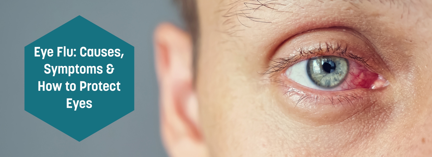 Eye Flu: Causes, Symptoms & How to Protect Eyes – My blog